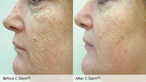 C-Stem® – CosMedical Technologies